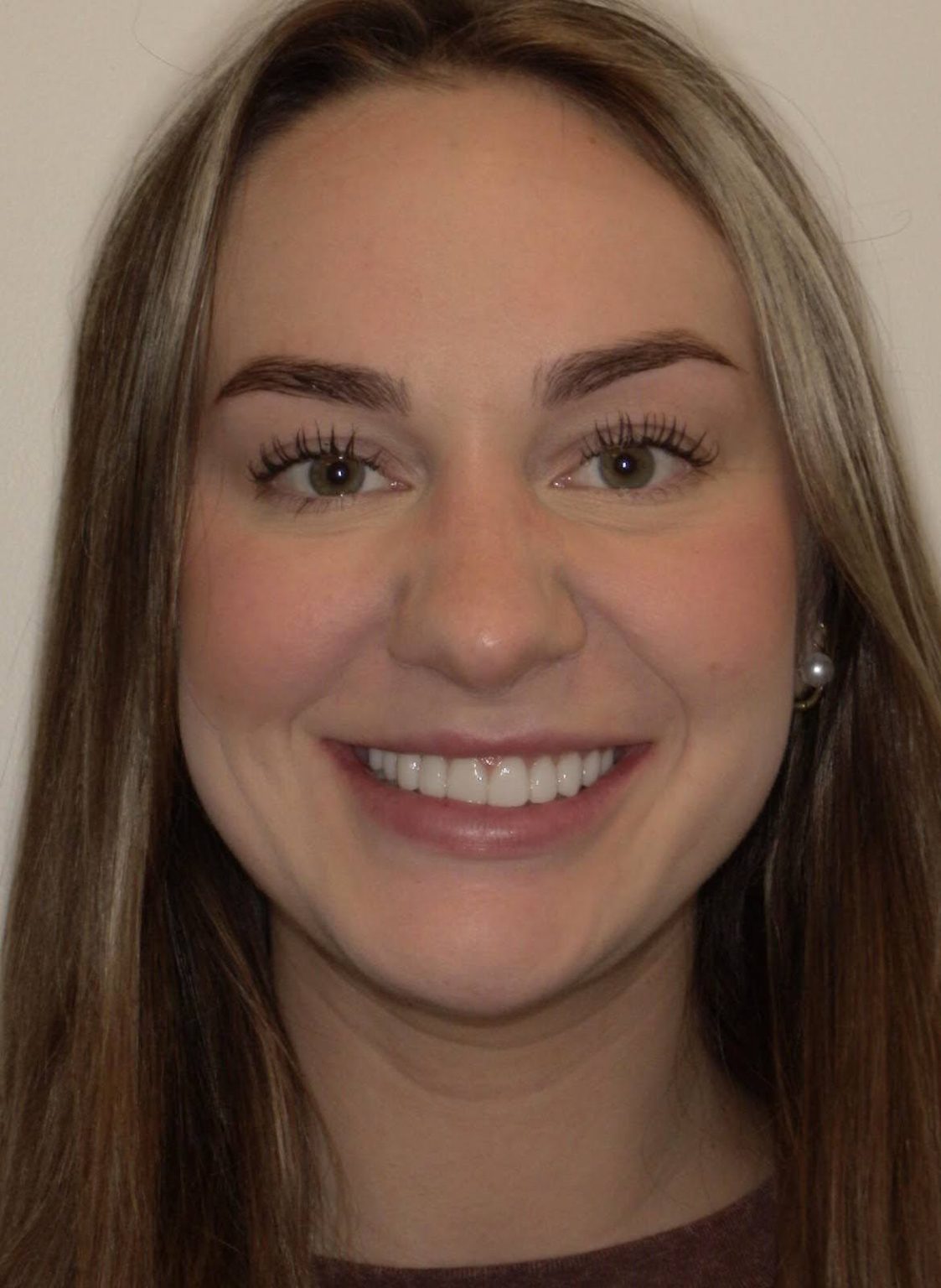 A Complete Smile Transformation: How We Addressed Function and Beauty ...